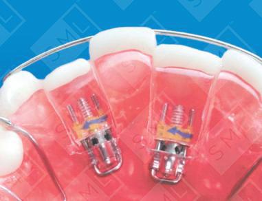 Mini-Screw Appliance U , Individual Tooth Movement Appliance, Dental ...