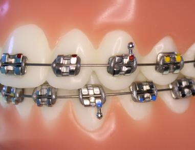 SML Mini Bracket Set, Orthodontic Brackets | SML | Southwest