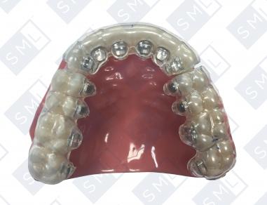 Brackets, Lingual Brackets, Orthodontic Brackets | SML