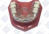 Dental Splints, TMJ Splints, Custom Splints Dentistry | SML